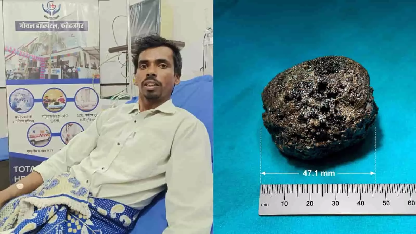 फतहनगर: मरीज के मूत्राशय से निकाली 200 ग्राम वजनी पथरी, सफल सर्जरी ...